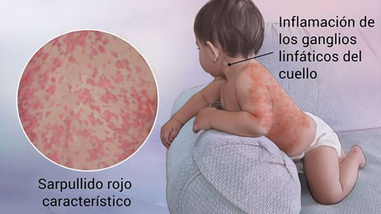 Confirman caso de rubeola en Ciudad de Buenos Aires y emiten alerta ...
