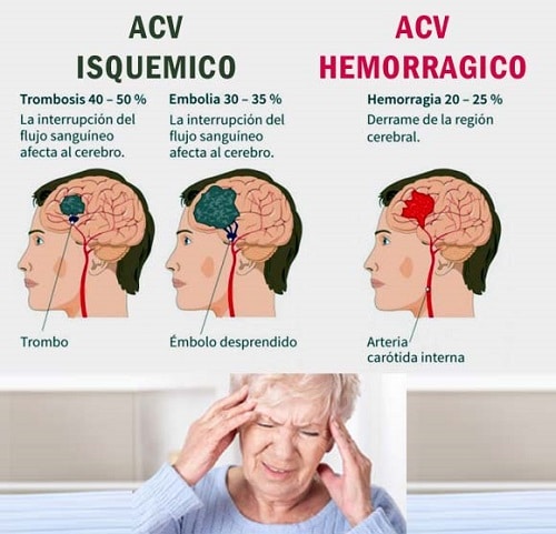 Ressonancia Magnetica De Acidente Vascular Cerebral Isquemico Vs Hemorragico
