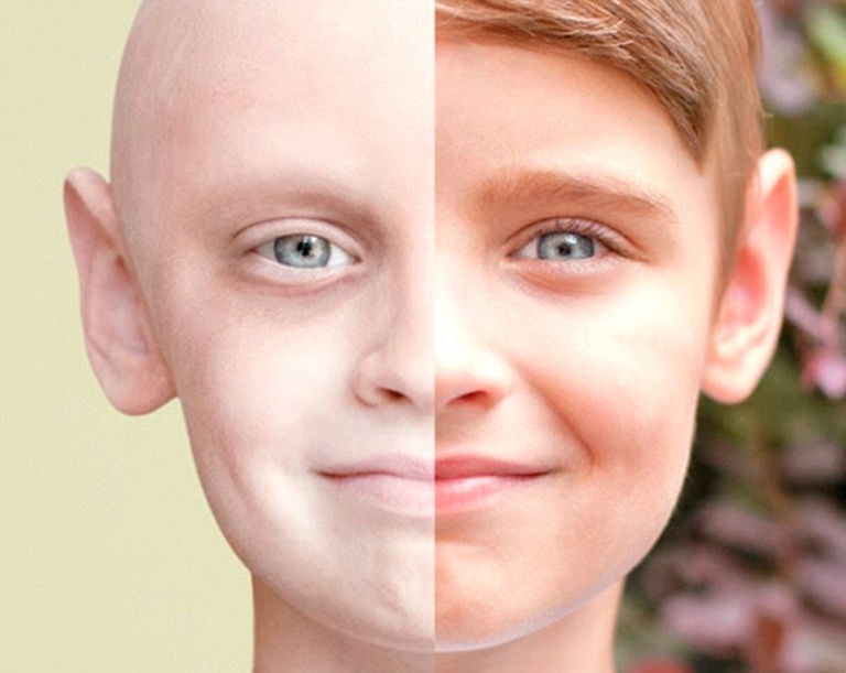 Nueve de cada diez pacientes con leucemia ya pueden tratarse sin ...