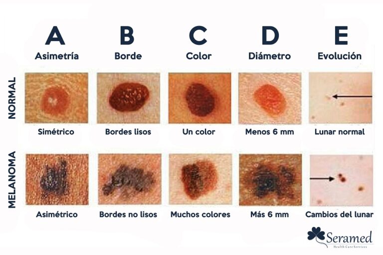 Día Mundial del Melanoma: principales riesgos, cómo detectarlo y cómo evitarlo - Primera Edición