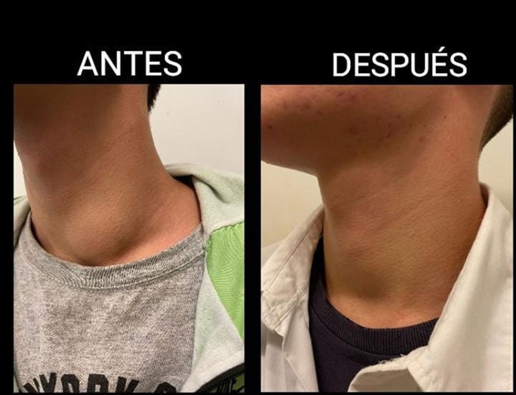 Día Mundial del Cáncer de Tiroides: prestar atención a los nódulos en ...